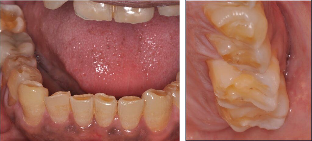 The Dark Side of Lemon Water: A Case Study - Dental Health Concepts