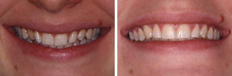 Minimally Invasive Esthetics to a Stellar Smile - Dental Health Concepts